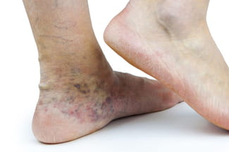 Edema arti inferiori: cause e rimedi